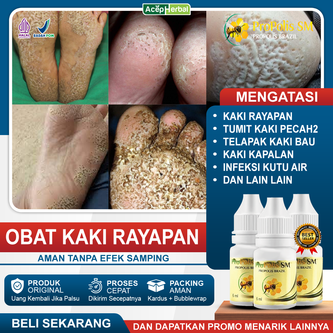Obat kaki Rayapan Kapalan Penghalus Tumit Kaki Pecah2 Gatal Kutu Air ...