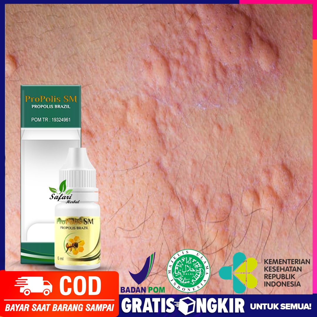 Obat Biduran/Alergi Dingin, Gatal Gatal Kaligata, Bentol Gede Di ...