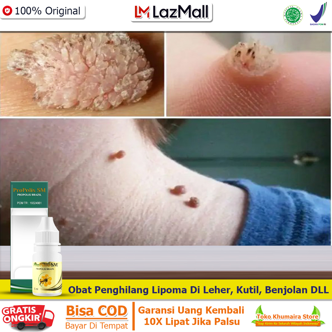 Terbukti Obat Penghilang Papiloma Di Leher Dengan Propolis Sm Asli ...