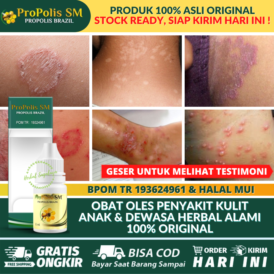 Obat Koreng Alami 100% Asli, Obat Koreng di Kaki / Koreng di Tangan ...