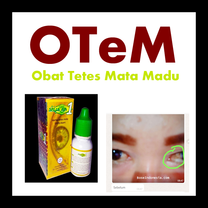 Obat Tetes Mata Madu (OTEM)/Menyehatkan mata/Meredakan peradangan mata ...
