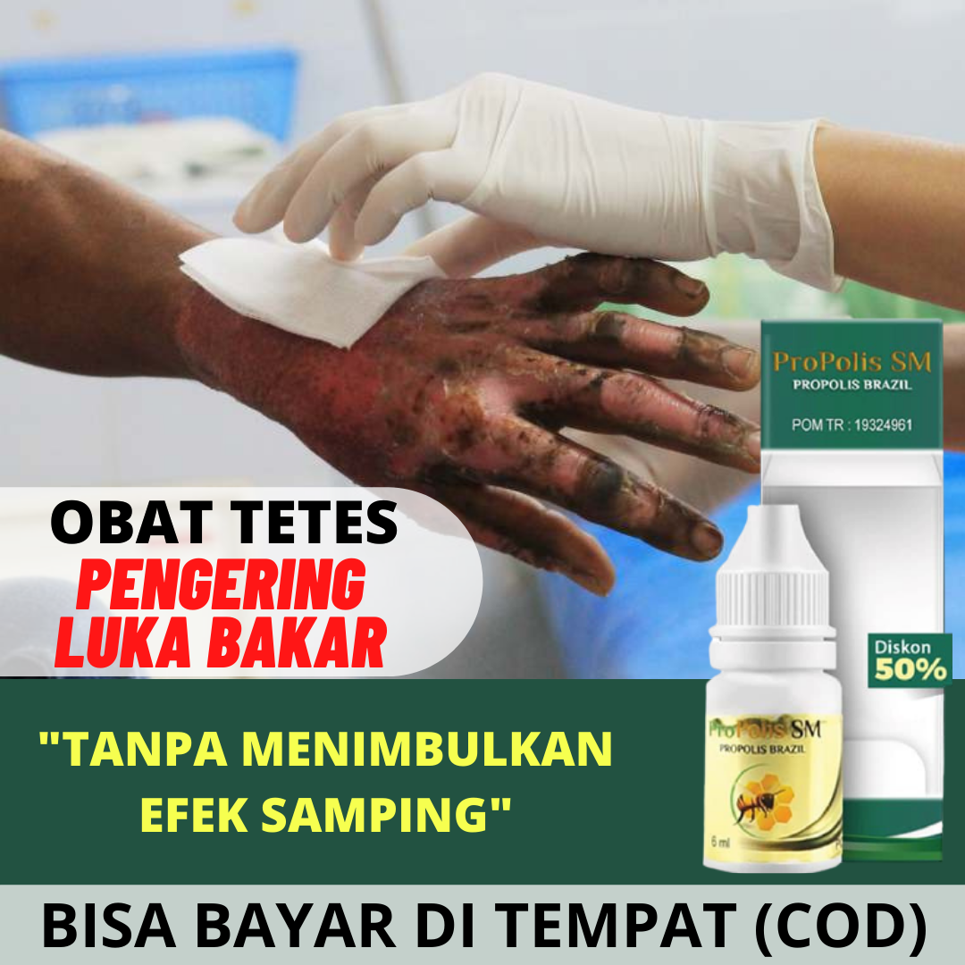 Obat Tetes Pengering Luka Bakar - Obat Luka - Luka Berdarah - Luka ...