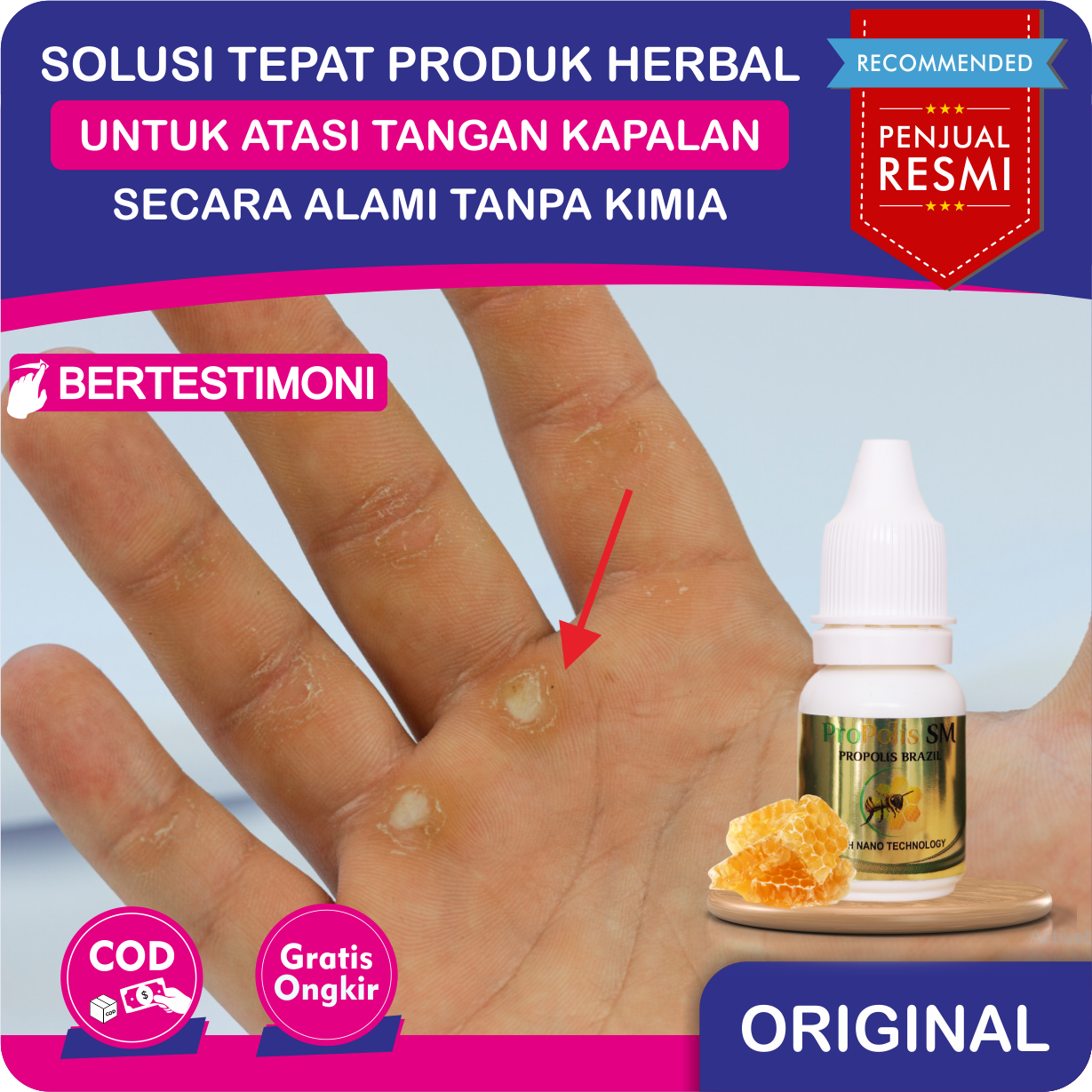 Obat Alami Kapalan Di Tangan, Obat Penghilang Kapalan Di Telapak Tangan ...
