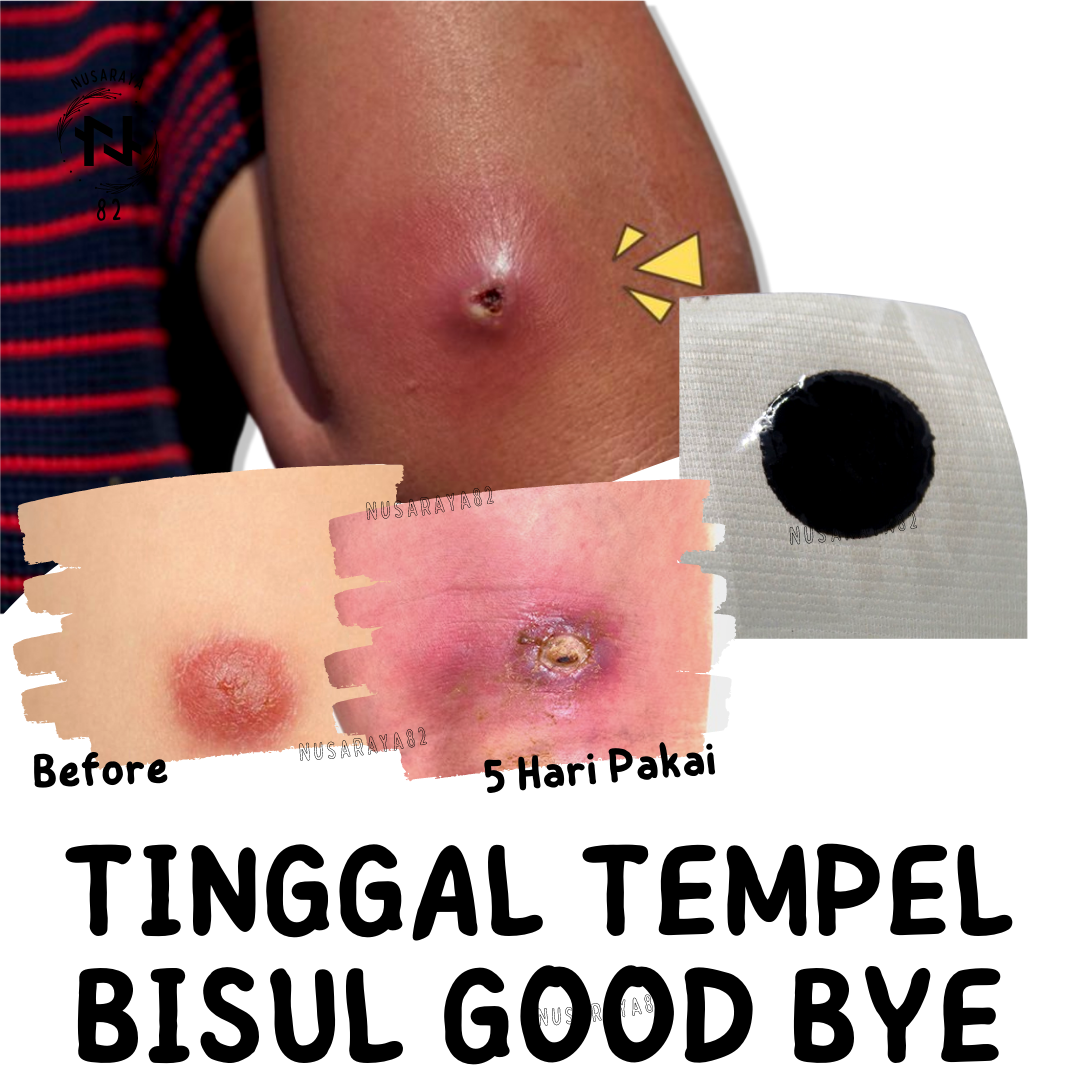 Obat Bisulan Paling Ampuh Plaster Hansaplas Perekat Penghilang Benjolan ...