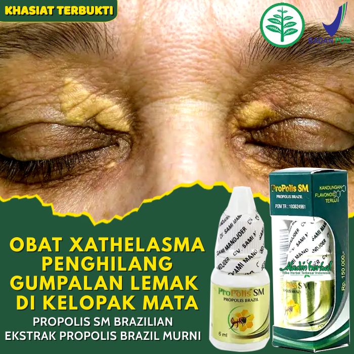 Propolis - Obat Xhantelasma - Obat Penghilang Xanthelasma Lemak Mata ...