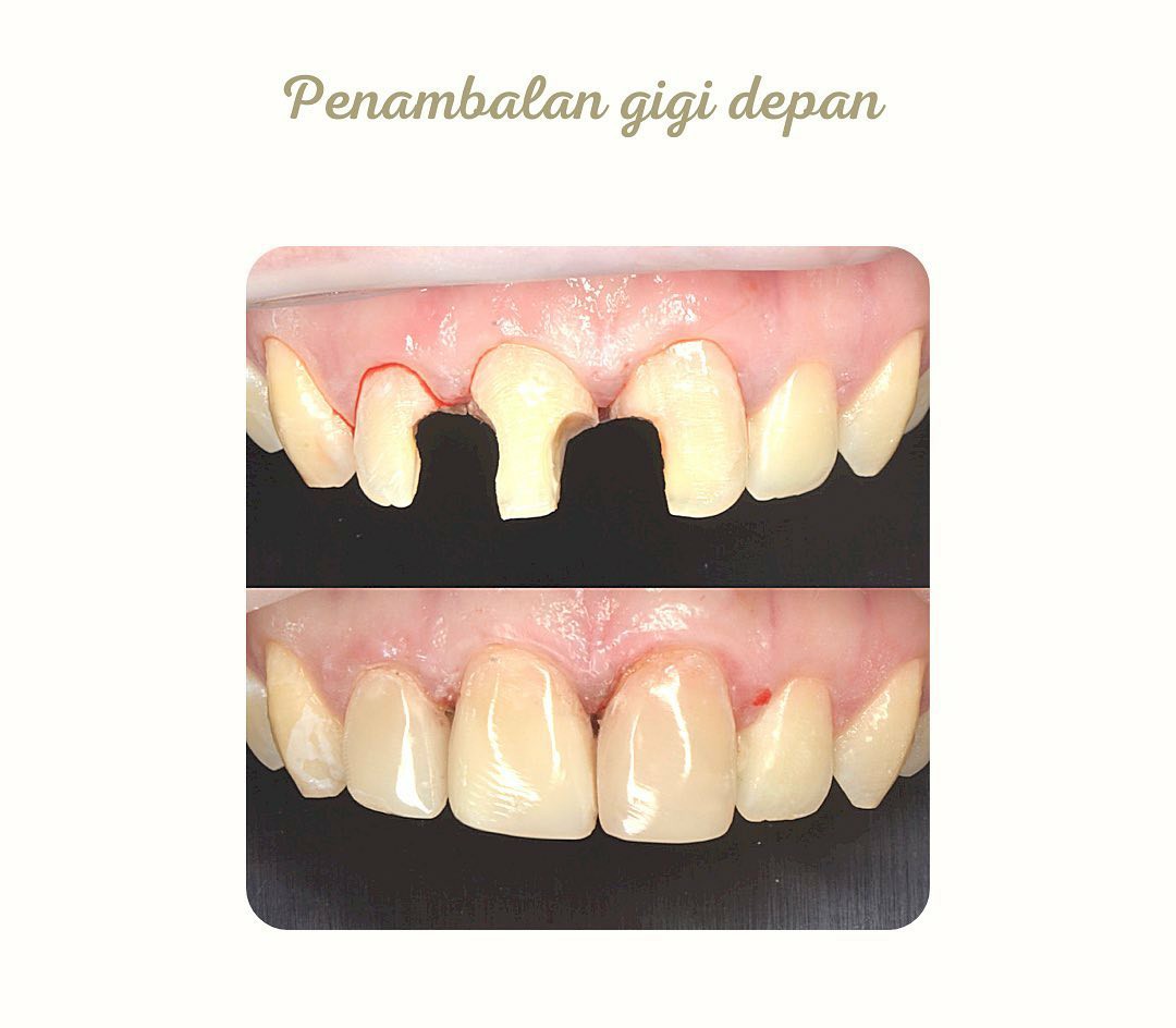 Tambal Gigi Berlubang Permanen Temptooth Bahan Gigi Palsu Original ...