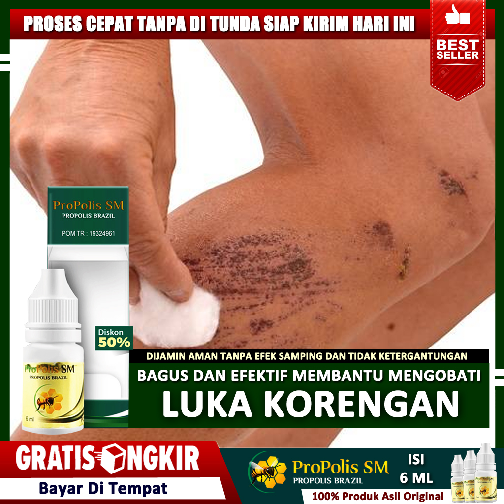 Obat Korengan Di Kaki, Korengan Di Pantat, Korengan Bernanah, Korengan ...