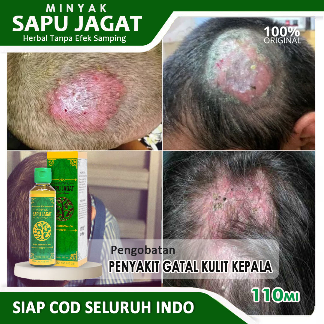 Obat Kulit Kepala Kering Dan Gatal, Obat Infeksi Jamur Di Kulit Kepala, Obat Borok Di Kepala ...