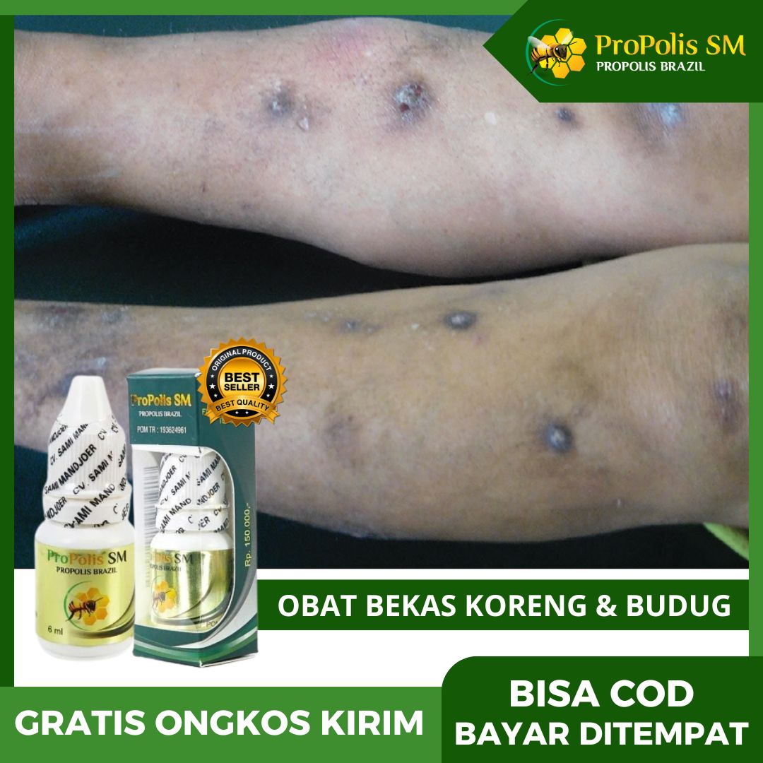 Propolis SM - Obat Oles Budug, Borok, Tetes Gatal Bernanah, Herpes ...
