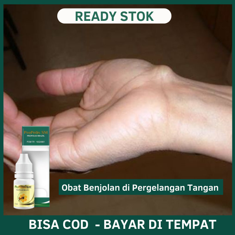Obat Benjolan di Pergelangan Tangan, Obat Kista Ganglion, Obat ...