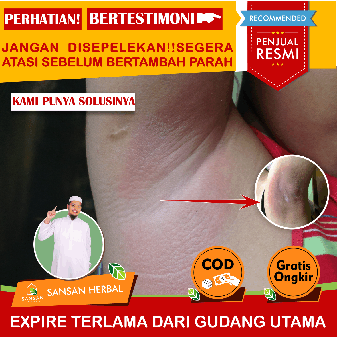 Obat Ruam Ketiak, Obat Untuk Ruam di Ketiak, Obat Ruam Kulit Ketiak ...