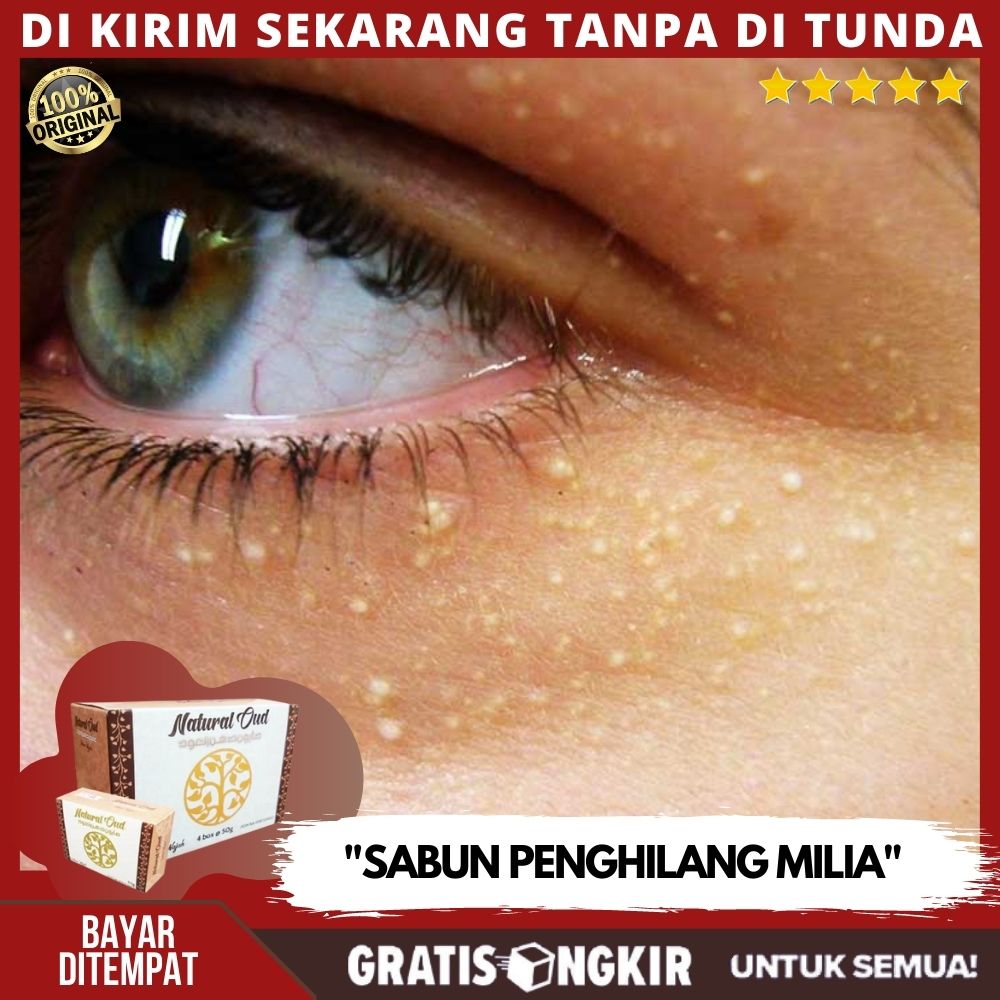 Obat Milia Di Wajah Natural Oud - Bintik Bintik Di Wajah, Buat Ngilangin Kriput, Penghilang ...