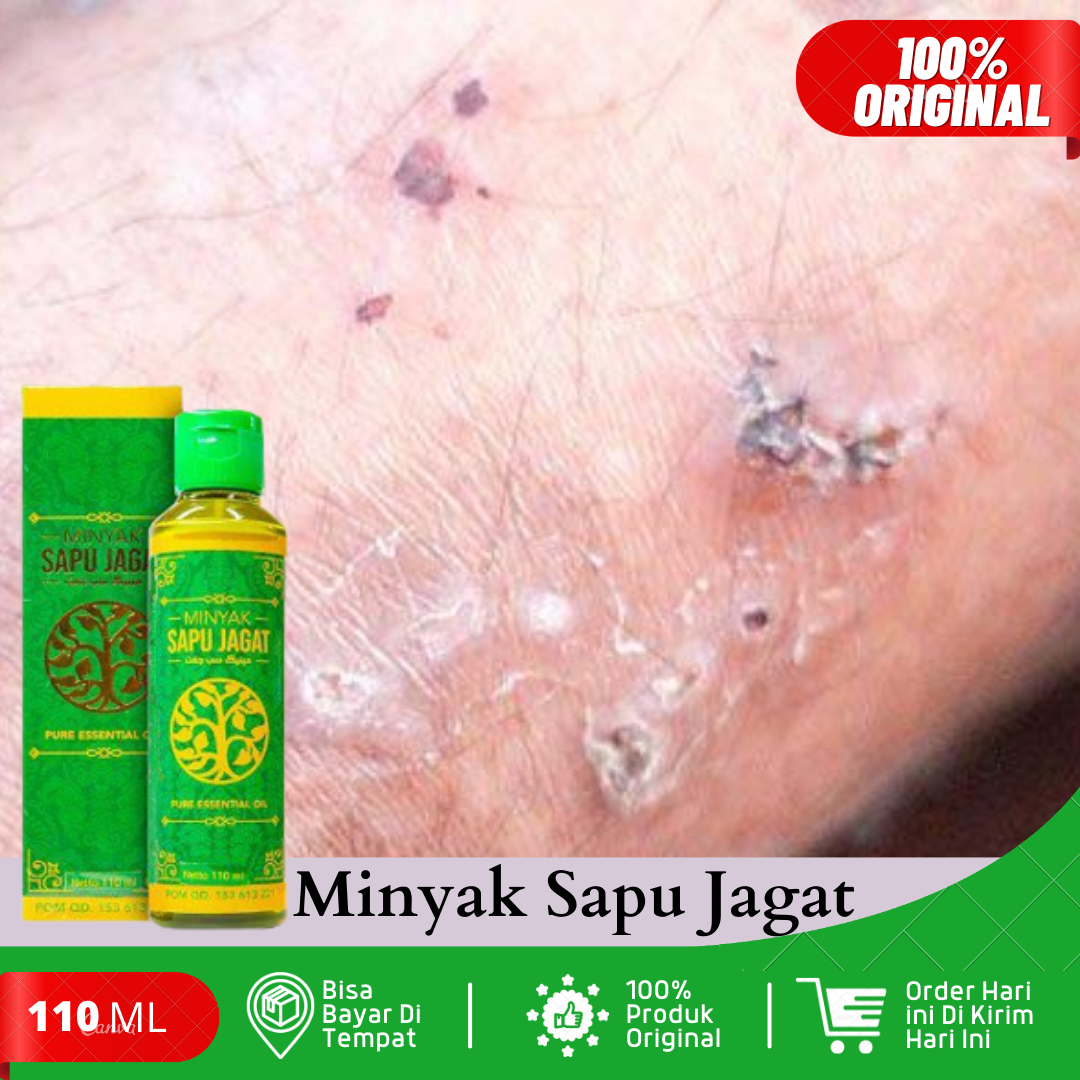 Obat Gatal Scabies, Obat Scabies Manusia, Obat Pembasmi Kudis Scabies ...