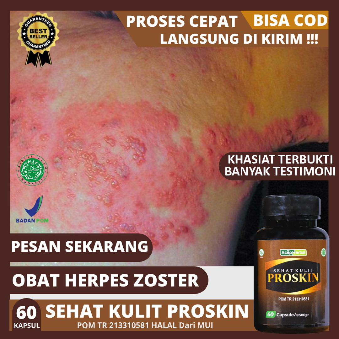 Obat Herpes Zoster, Obat Cacar Ular, Cacar Air, Cacar Api, Infeksi ...