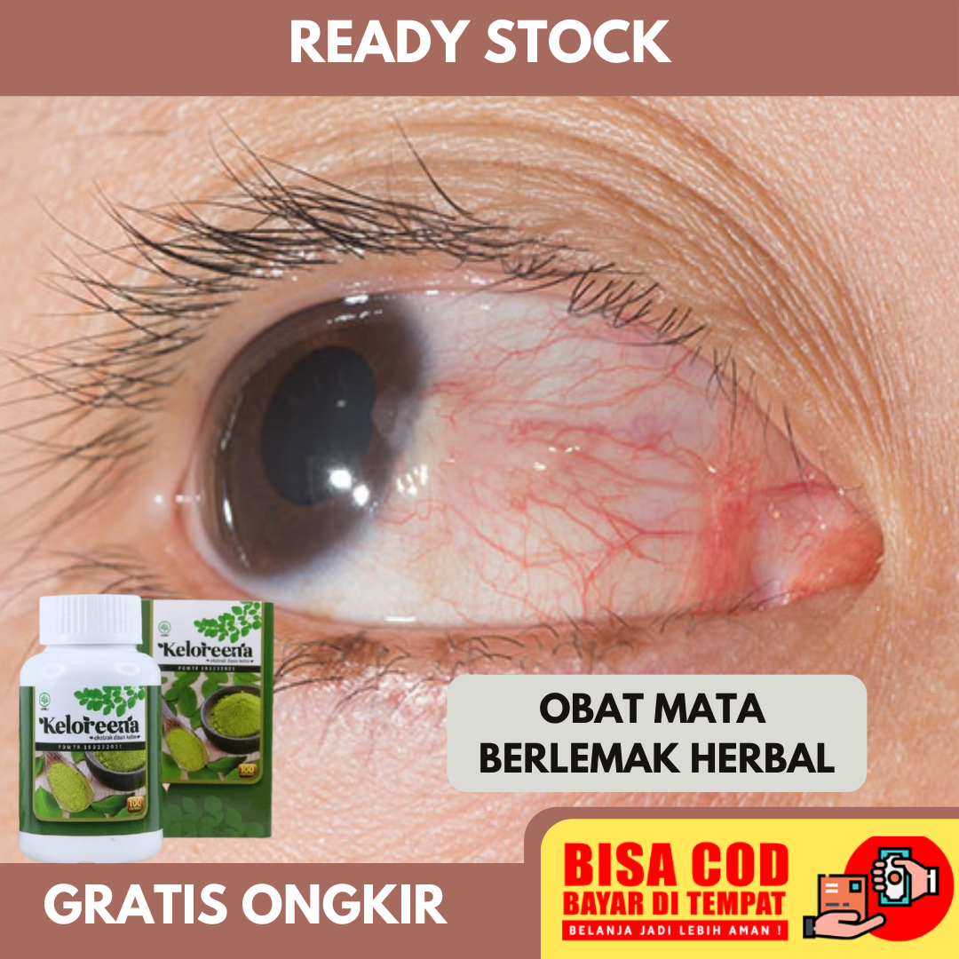 Obat Mata Berlemak, Obat Penyakit Pterigium, Obat Mata Pterygium, Obat ...