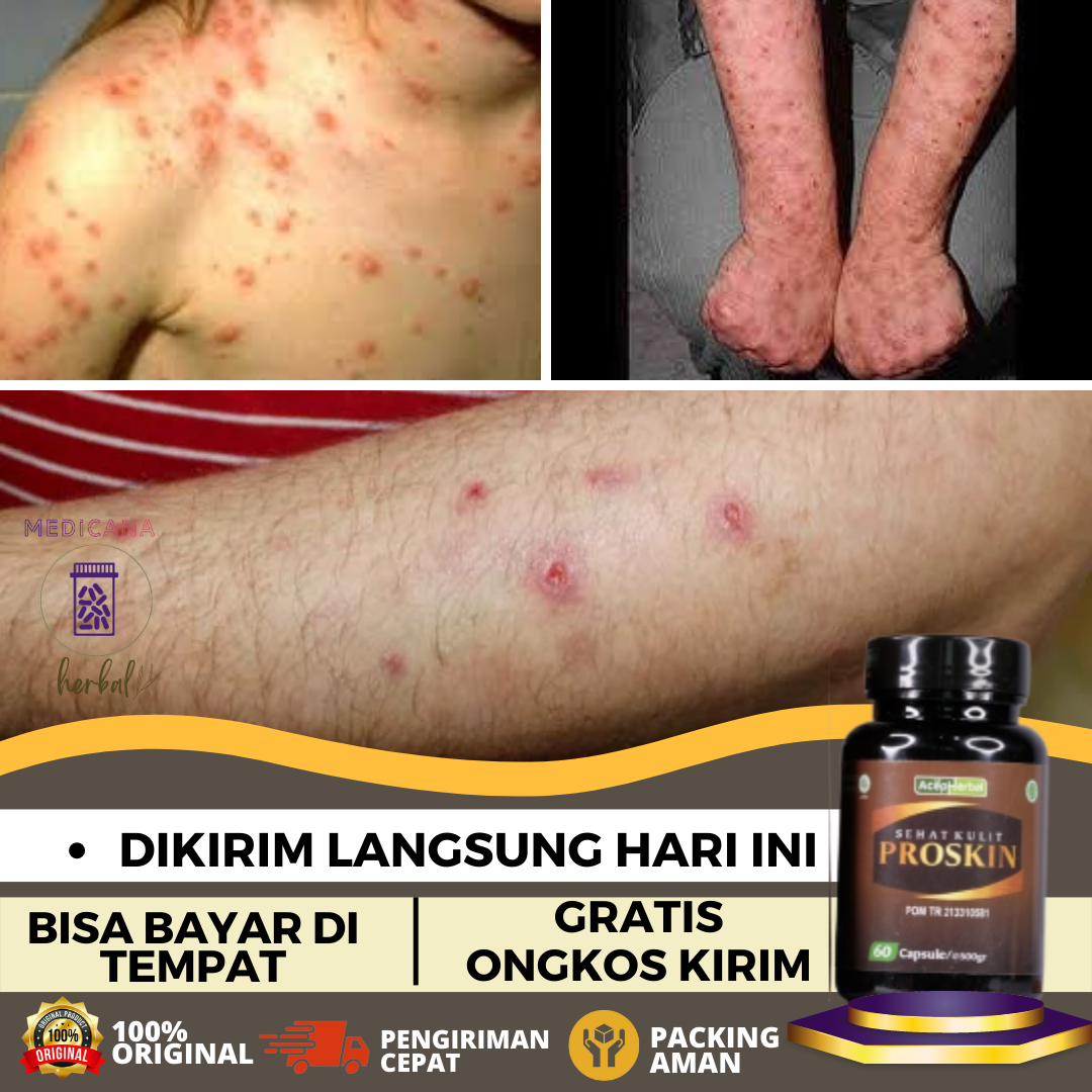 Obat Darah Manis, Obat Herbal Prurigo, Obat Gatal Darah Manis, Obat ...