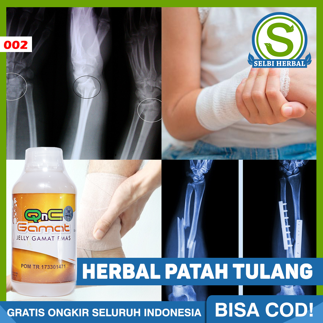 Herbal Patah Tulang - Patah Tulang di Kaki - Patah Tulang di Tangan ...
