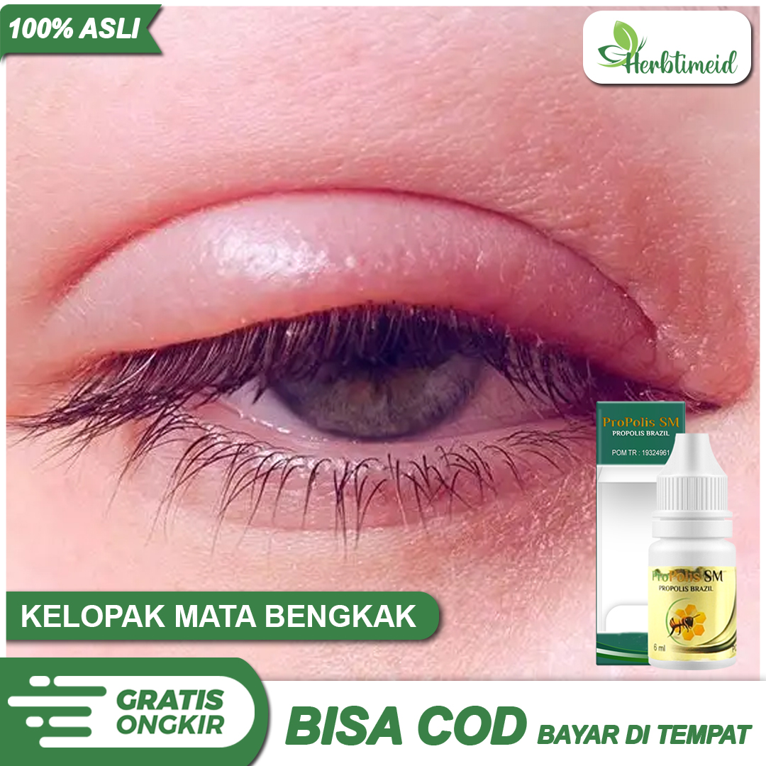 Obat Kelopak Mata Bengkak Bendul Bintitan Kalazion Sakit Saat Berkedip ...