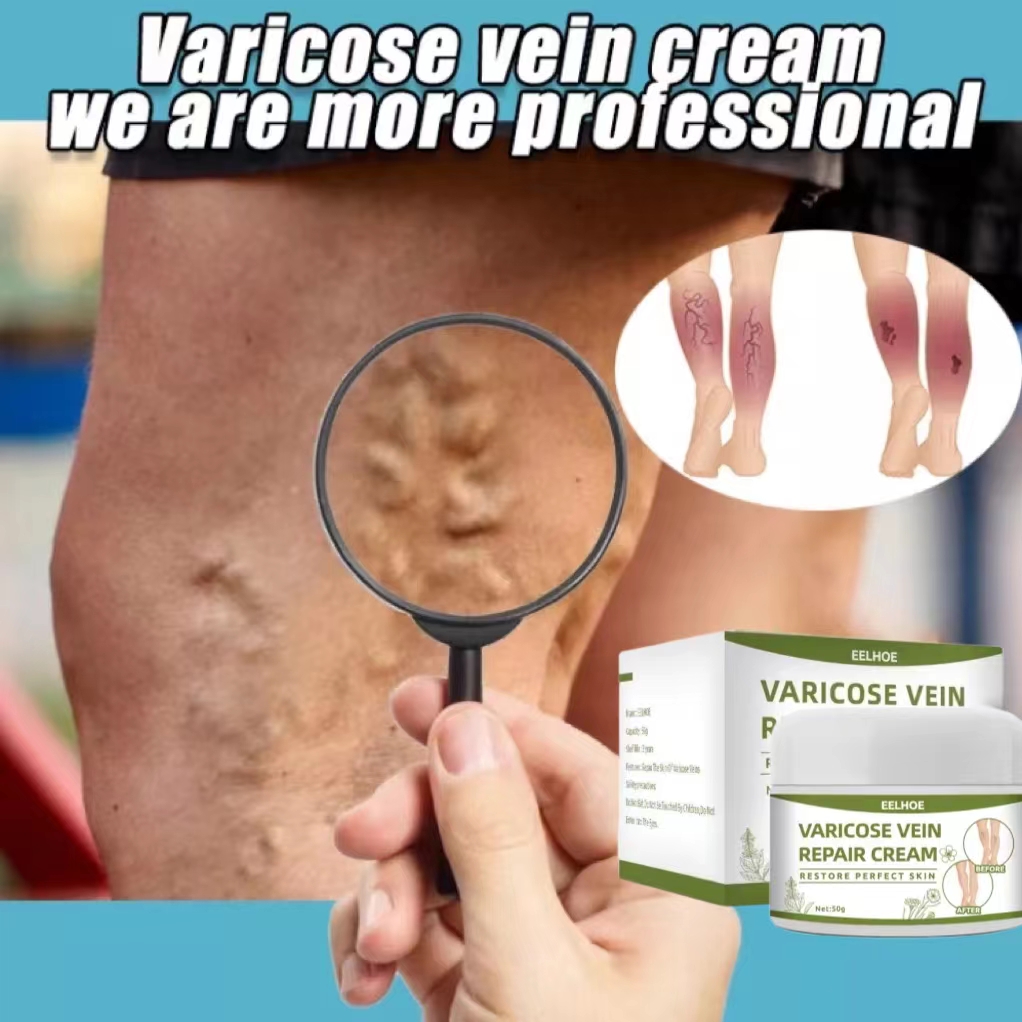 EELHOE Varicose Veins Perbaikan Cream Efektif Nyaman Ekstrak Tanaman ...