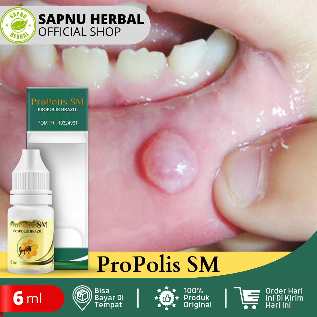 Obat Benjolan di Bibir Mulut, Penghancur Benjolan Di Langit Mulut ...