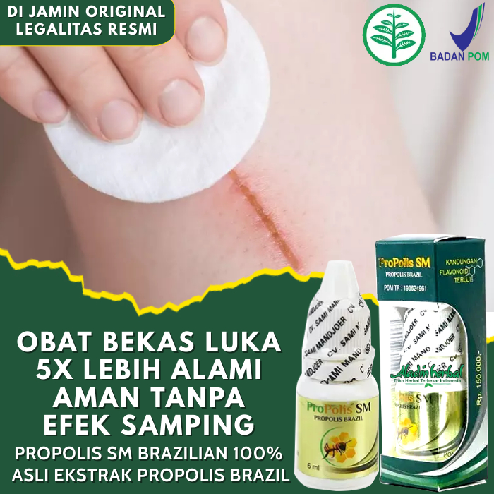 PROPOLIS SM - Obat Penghilang Bekas Luka 5x Lebih Alami - Obat Bekas ...