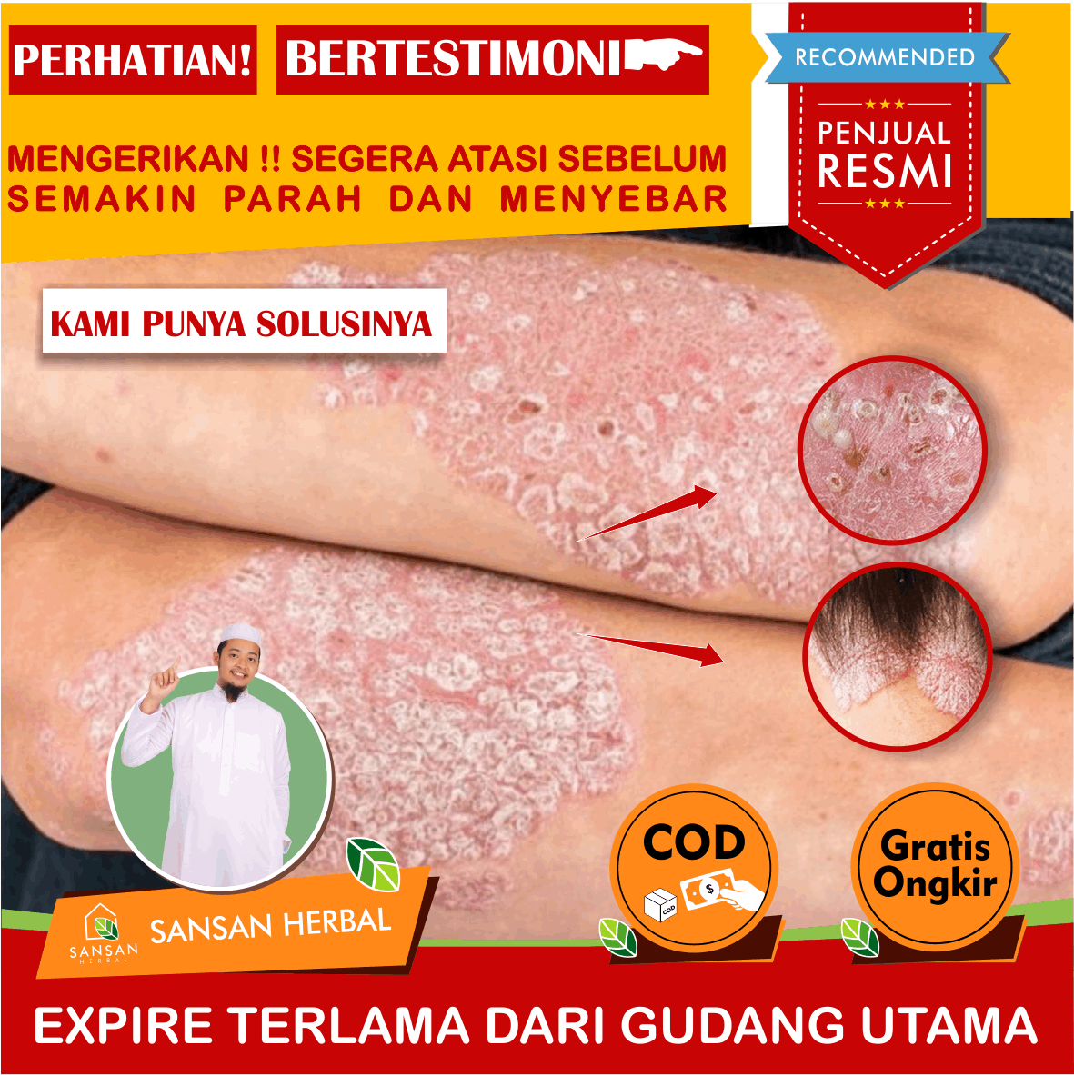 Cream Psoriasis, Obat Untuk Kulit Psoriasis, Obat Penyakit Kulit ...