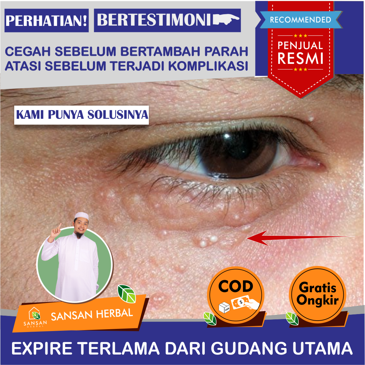 Obat Oles Buat Milia, Obat Oles Milia, Obat Ngilangin Milia, Obat Buat ...