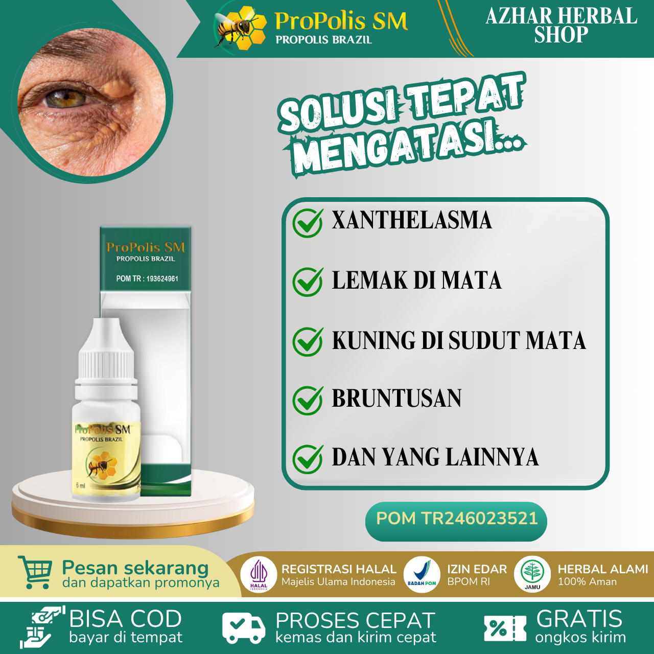 Propolis SM Obat Xanthelasma, Gumpalan Lemak Di Kelopak Mata, Gumpalan ...