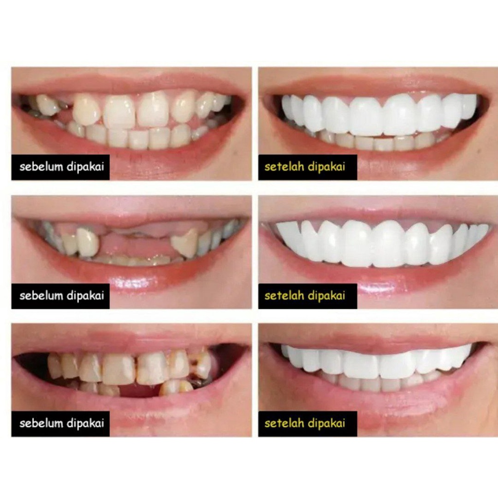 Snap On Smile Gigi Palsu Atas Bawah Pria Wanita Snap on Smile Veneers ...
