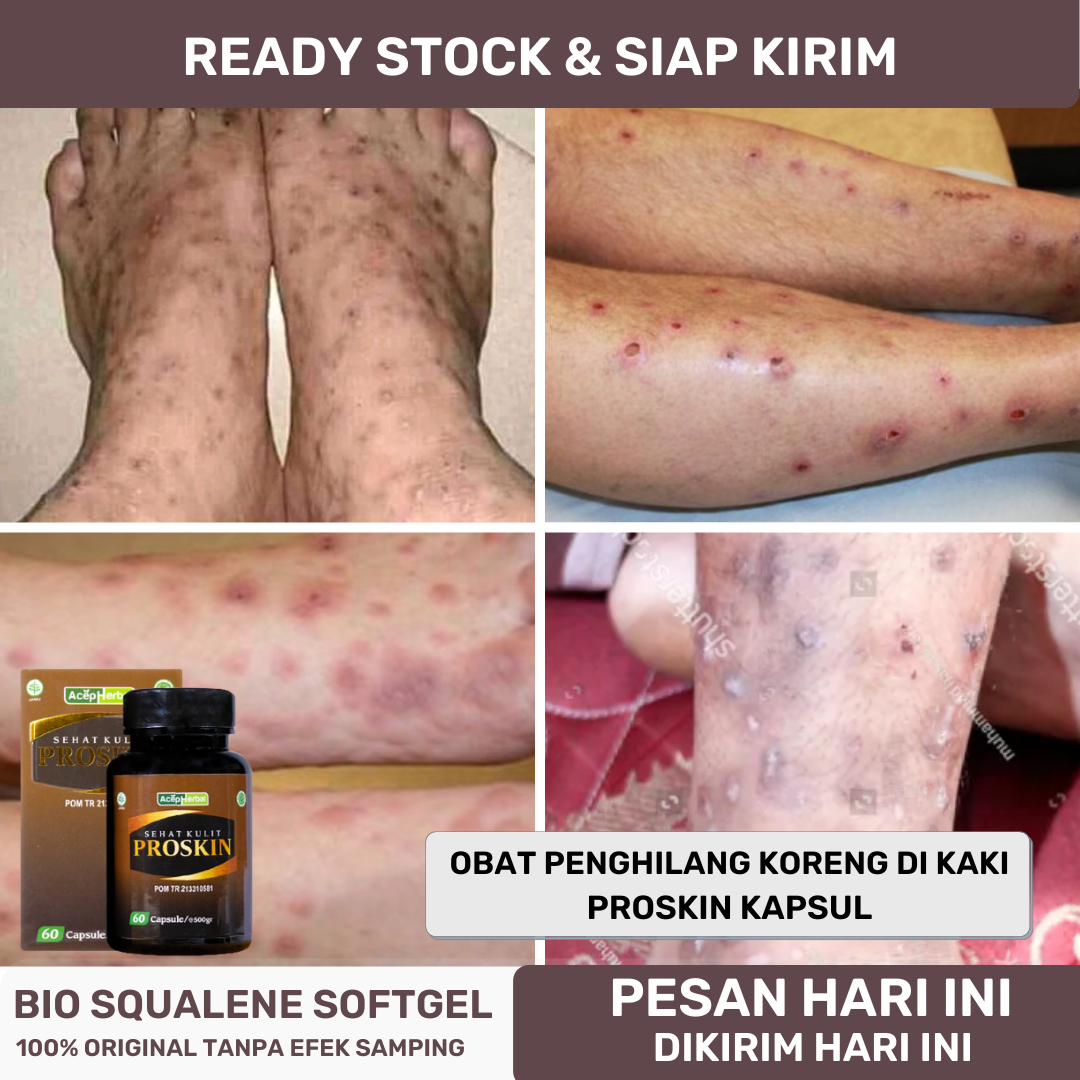 Proskin - Obat Koreng Di Kaki, Obat Koreng Bernanah, Obat Bekas Luka ...