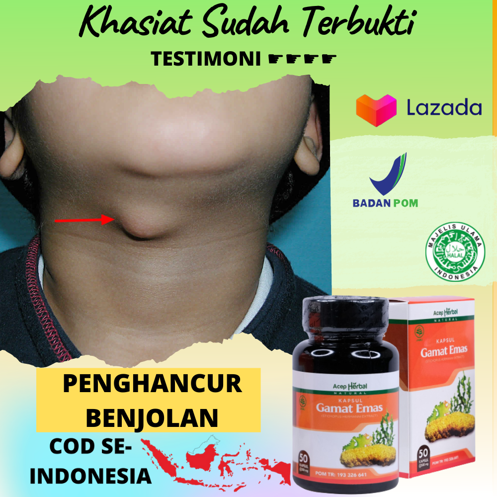 Obat Tumor Leher, Benjolan Di Leher Sebelah Kanan Kiri, Mengoabati ...