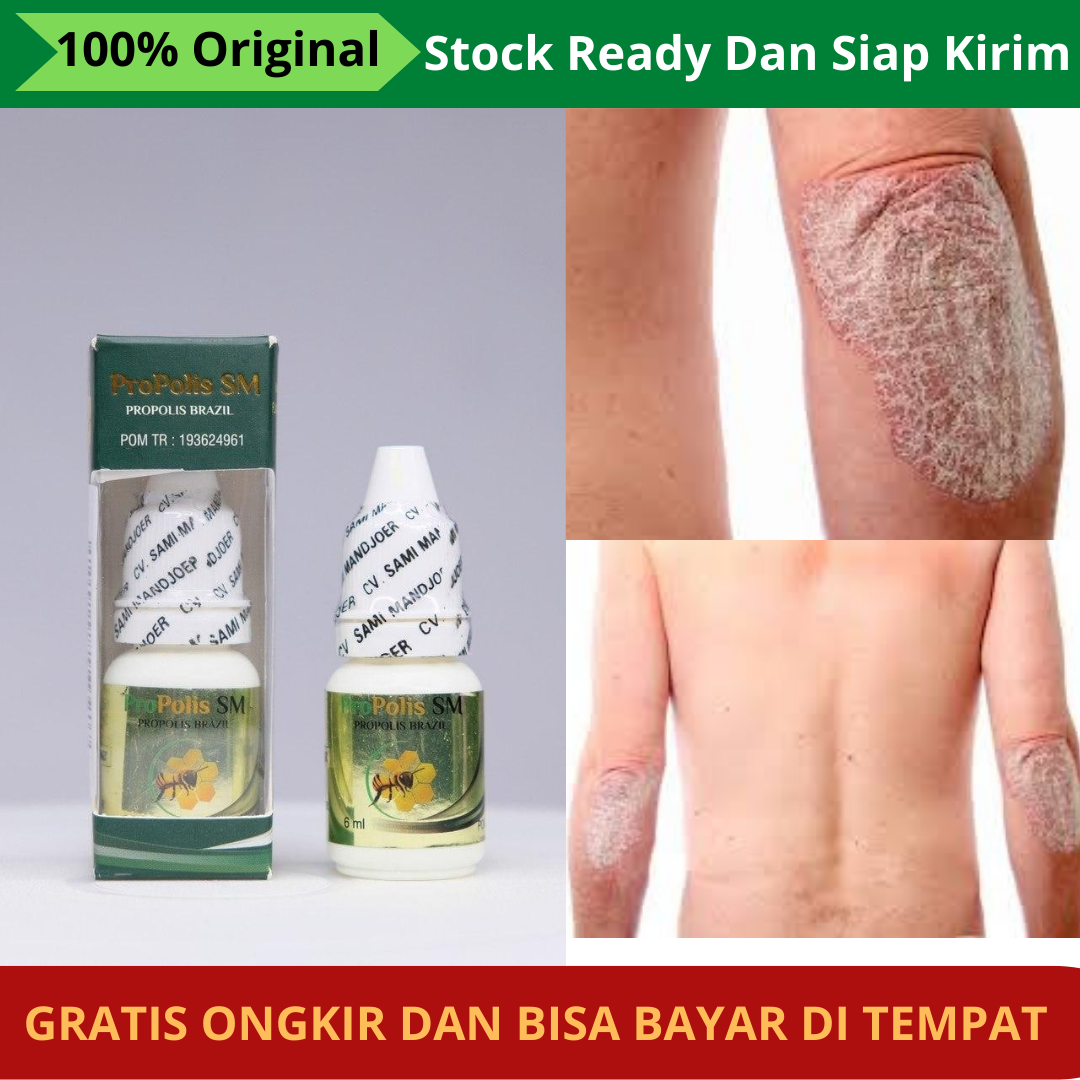 Obat Psoriasis Kulit Kering di Lutut Dan Siku, Obat Kulit Psoriasis ...
