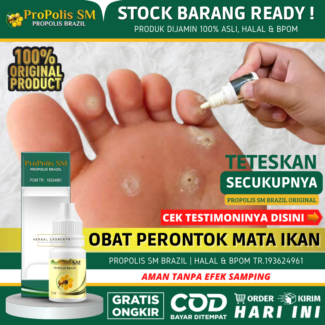 PROPOLIS SM - Obat Tetes Perontok Mata Ikan di Telapak Kaki & Tangan ...