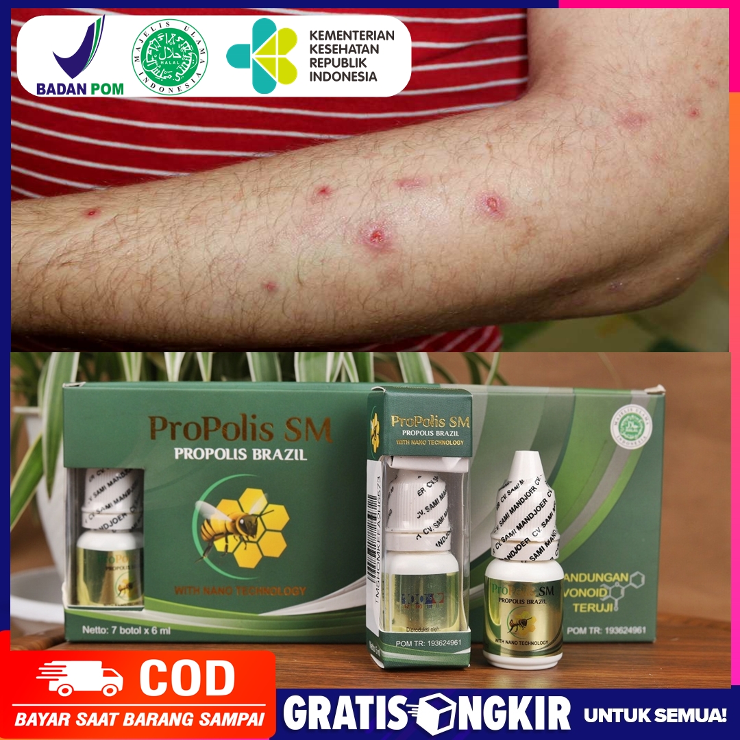 Obat Darah Manis, Prurigo, benjolan / bintil-bintil di kulit lengan ...