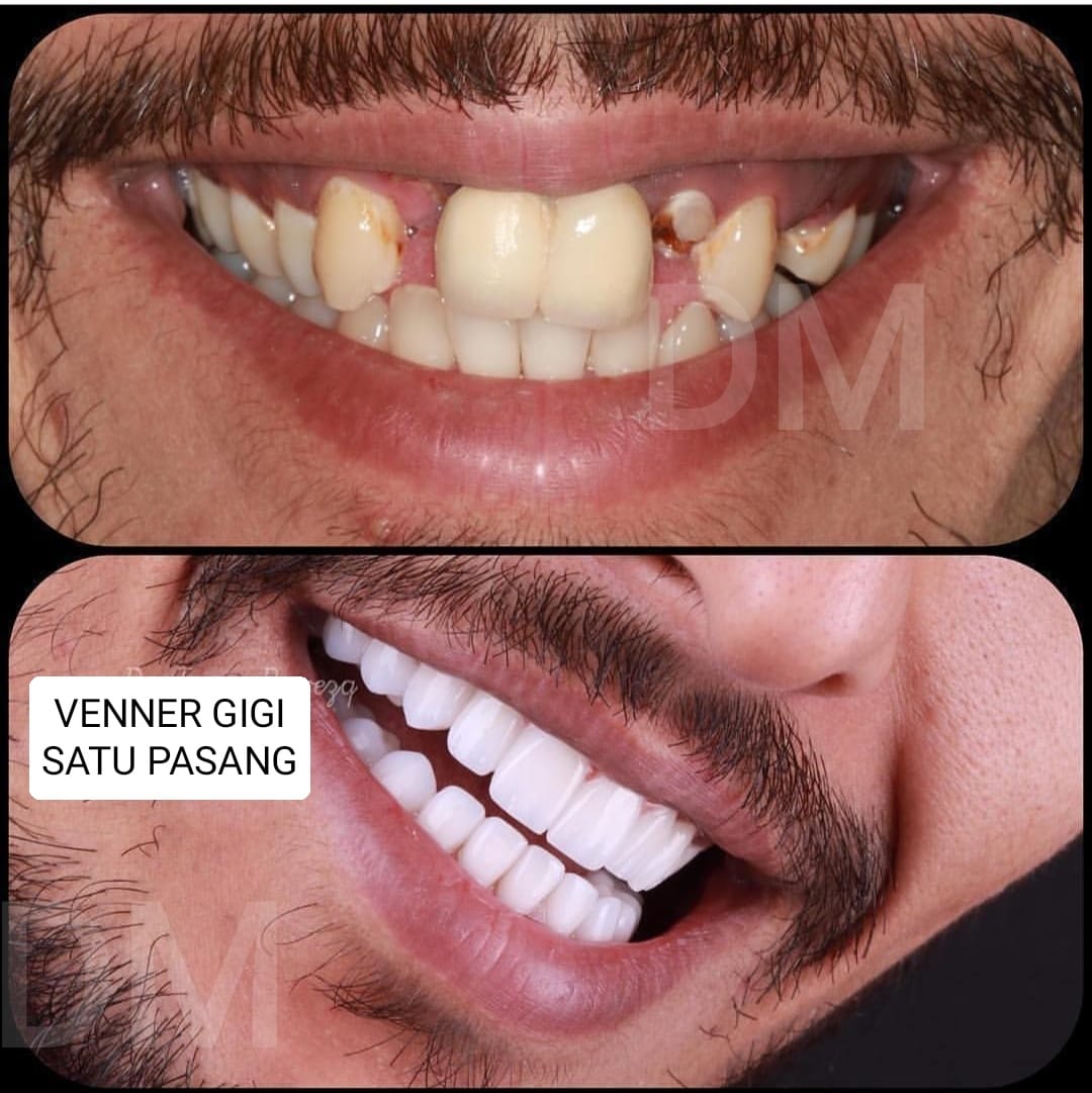 Sangat Kuat Satu Set Gigi Palsu Instan Atas Bawah Penutup Ompong Lepas Pasang Gigi palsu ...