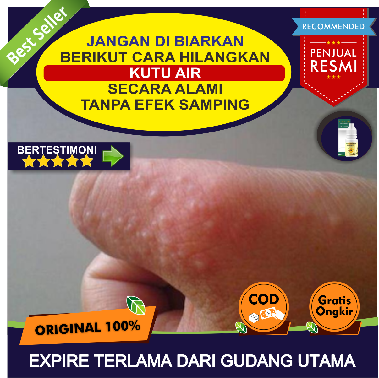 Obat Kutu Air Di Telapak Tangan Alami, Obat Kutu Air Di Kuku Tangan ...