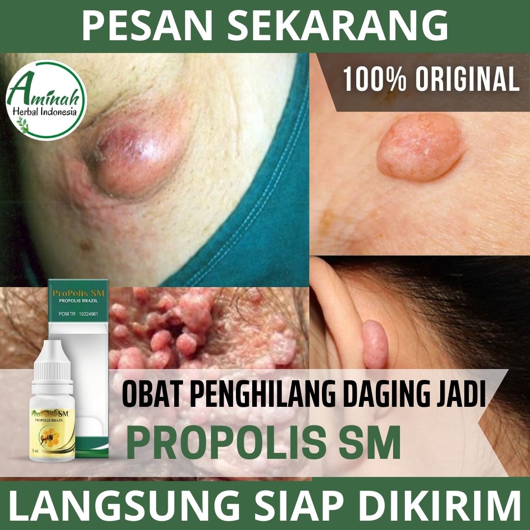 Obat Benjolan Daging Jadi - Obat Herbal Daging Jadi, Obat Daging Tumbuh ...
